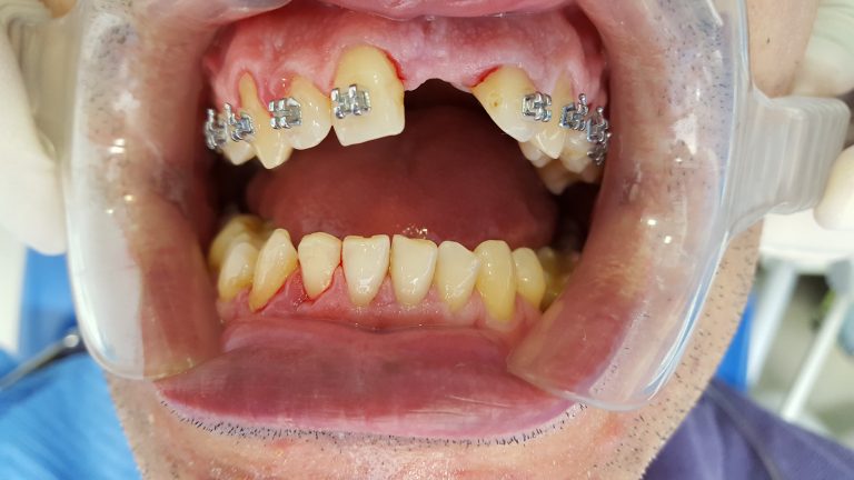 Caso clínico continuado de Ortodontia e Implantologia - Dental 360